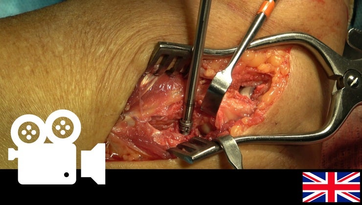 supinator crest avulsion