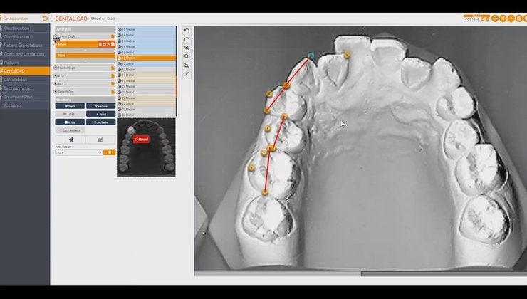 Smilestream DentalCAD - Model Measuring Tutorial | AlignerMaster.com CE ...
