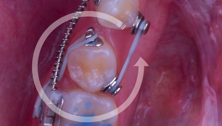 Correcting Rotations in Orthodontics- Part 1 | AlignerMaster.com CE on ...