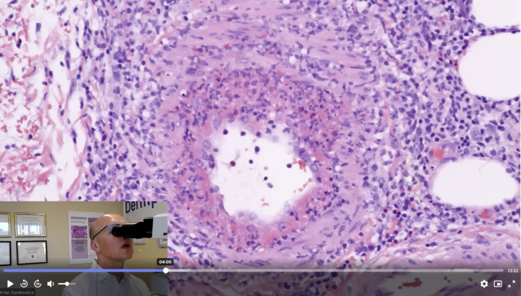 Have you heard about macular lymphocytic arteritis?