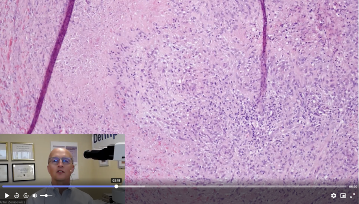 Necrotizing lobular panniculitis: erythema induratum | Dermpedia