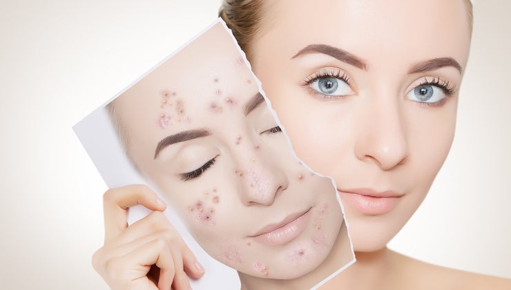 Ways to Find out Acne Imposters | Pro Skin Care Training