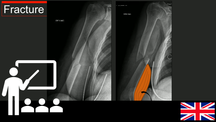 Understanding Humerus Midshaft Fractures