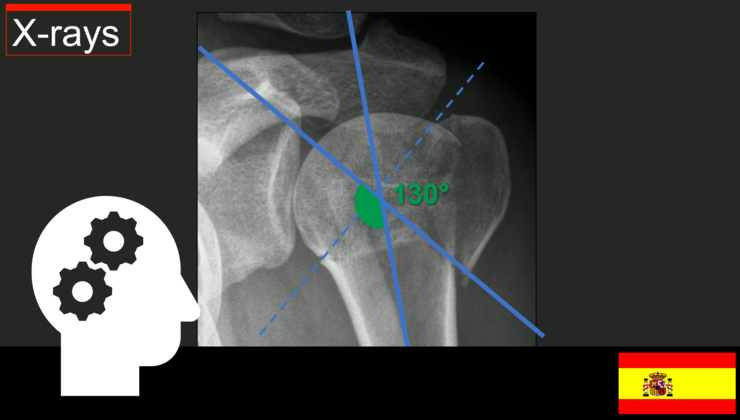Fractura de Humero Proximal - Reducción Abierta y Fijación