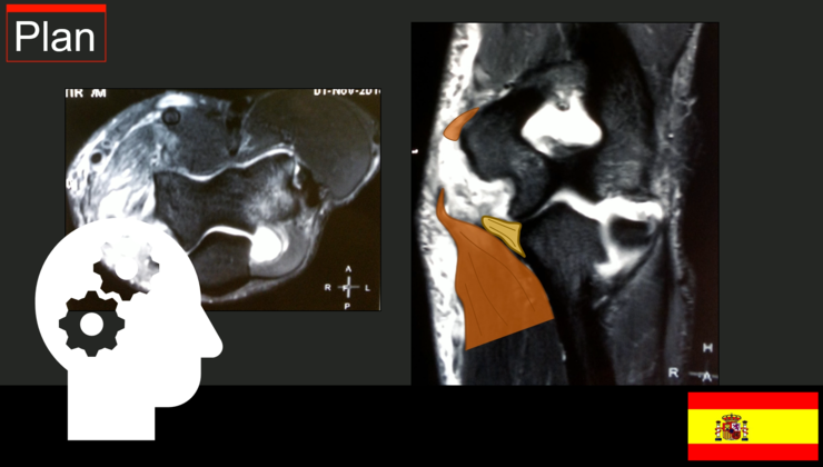 Inestabilidad Traumática en Valgo de Codo.