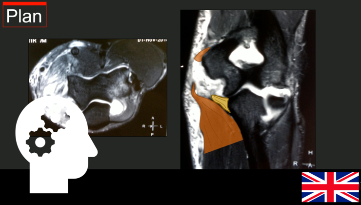 Acute Valgus Traumatic Instability of the Elbow.