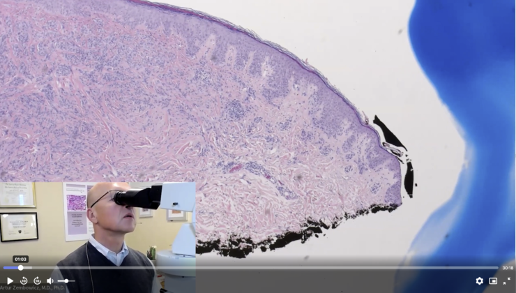 Nevoid melanoma or clonal deep penetrating nevus