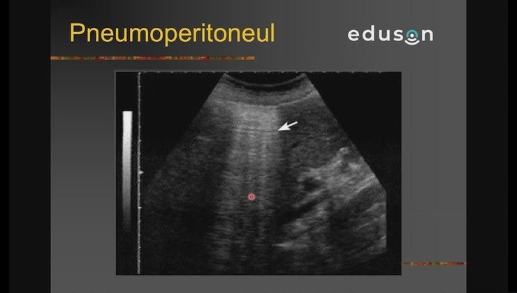 Patologia peretelui abdominal şi a peritone