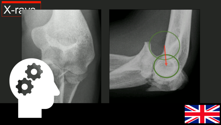 Transolecranon fracture dislocation