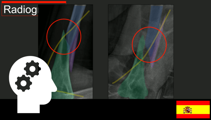 Fractura de diáfisis humeral con paresia radial | Orthoflix Simall