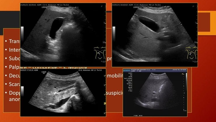 Anatomia colecistului. Functia. Variante anatomice. Aspect US. Normal