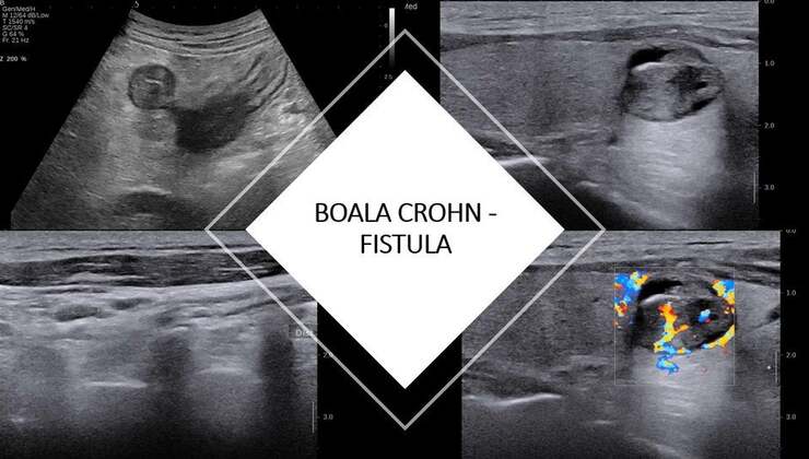 Ultrasonografia a colonului. Terminologie. Artefacte. Manipularea ...