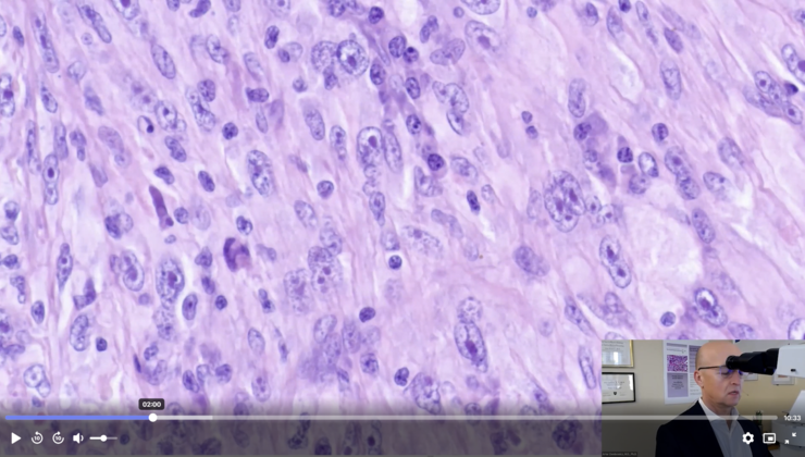 Pleomorphic dermal sarcoma with aberrant expression of S100 | Dermpedia