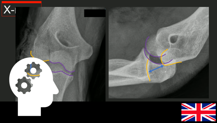 Open elbow dislocation