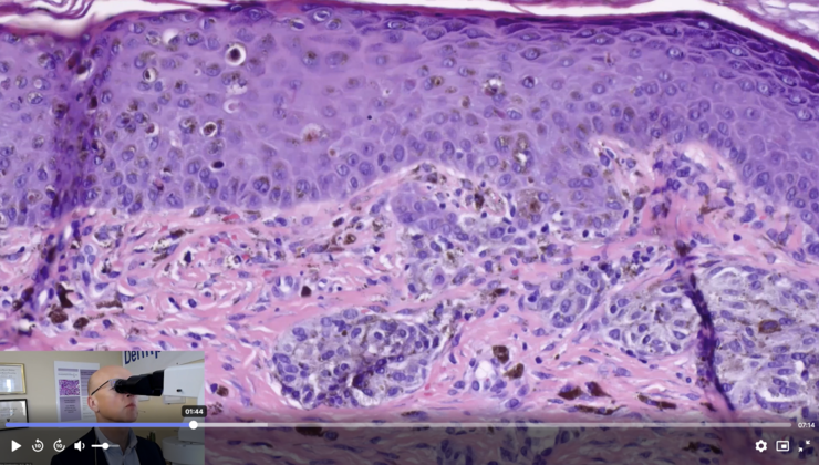 Atypical recurrent nevus phenomenon or melanoma? | Dermpedia