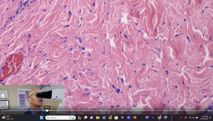 CD34-positive neoplasm on the eyelid