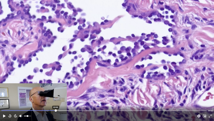 Retiform hemangioendothelioma | Dermpedia