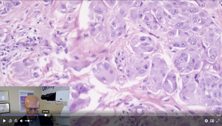 MAP3K8 Fusion Atypical Spitz Tumor with p16 loss | Dermpedia