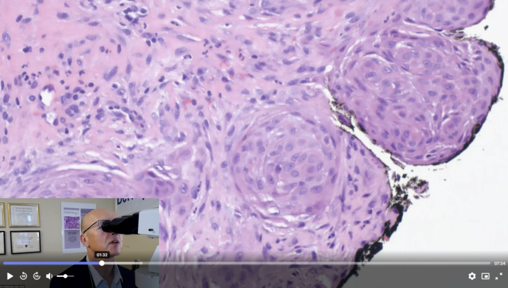 Endophytic well-differentilated squamous proliferation | Dermpedia