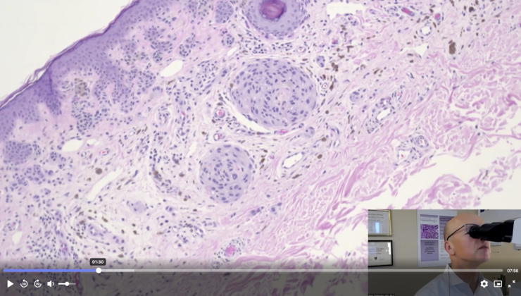 Dysplastic nevus with severely atypical clonal dermal nests | Dermpedia