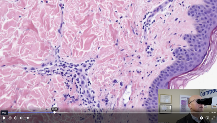 Early leukocytoclastic vasculitis?