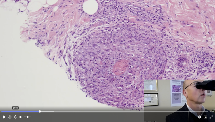 Unusual "Kerion Dermatitis" | Dermpedia