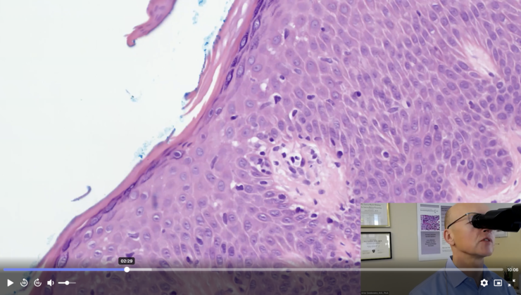 Large Plaque Parapsoriasis Versus Mycosis Fungoides Versus