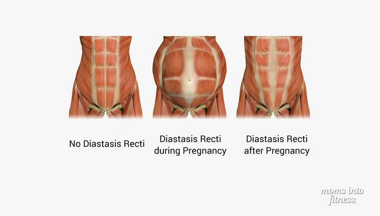 Diastasis Recti: do you have an abdominal separation?
