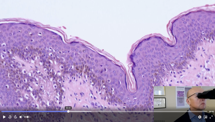 Recurrent Pigmented Lesion Melanoma Or Recurrent Nevus | Dermpedia