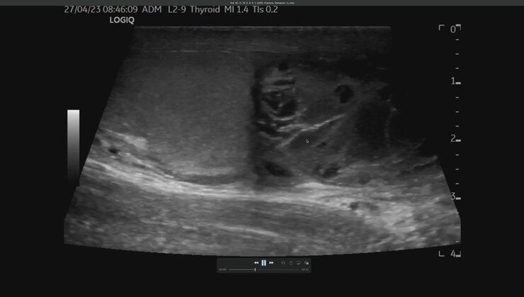 Sc. C. 10. 2. 3. 4. Hematom. Testicular. Stg. Hematocel. St. Post ...