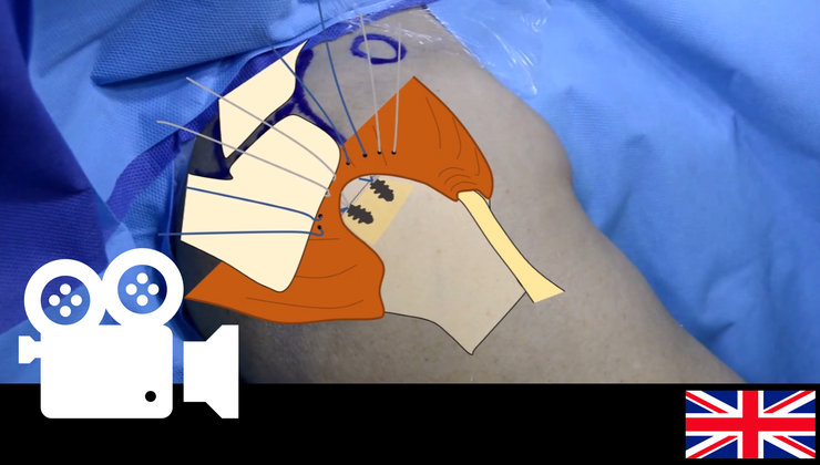 Complete Supraspinatus Tendon Rupture: Mini Open Repair.