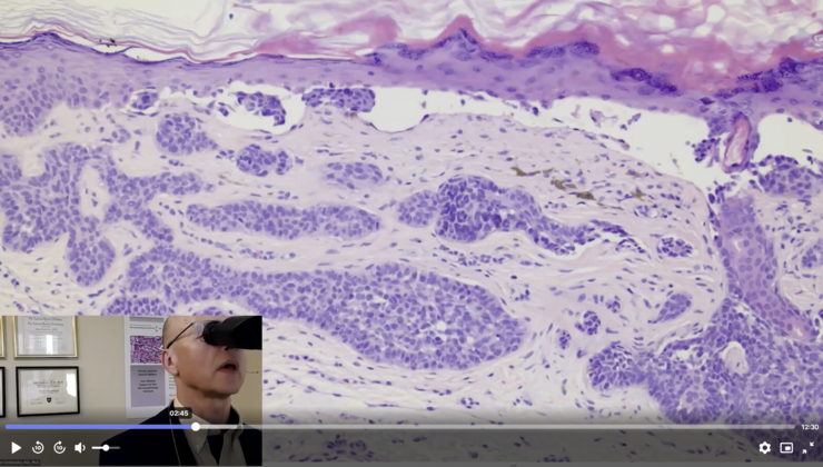 Colision Of Atypical Melanocytic Tumor And Basal Cell Carcinoma