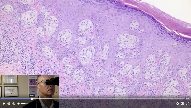 Spitzoid Melanocytic Tumor With Cytological Features Suggestive ...