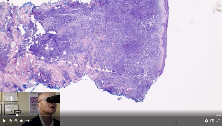 Bruise Like Lesion With Biopsy Showing Leukemia But Negative Flow And ...