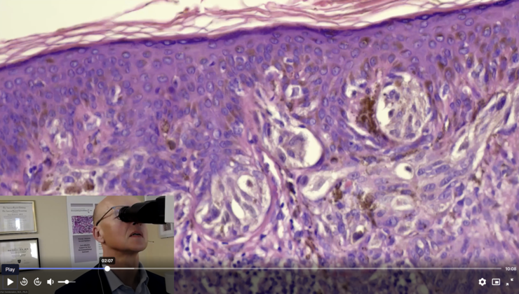 Spitzoid Melanocytic Tumor With Known Genetics Determined By Ngs ...
