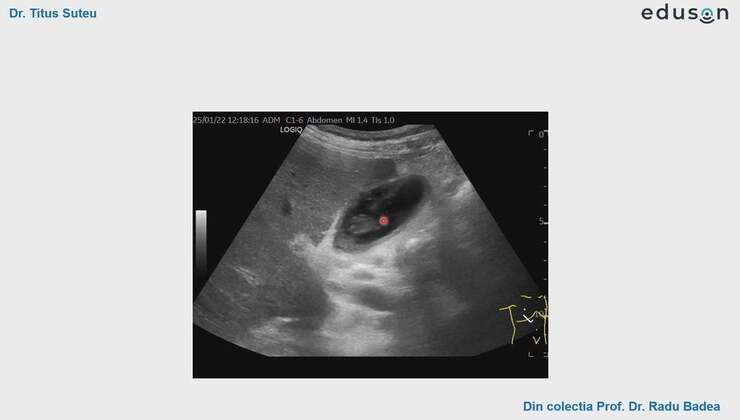 Tromb Hematic In Vena Porta Asociat Unei Colecistite Acute