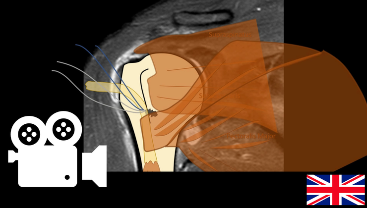 Biceps Tenotomy - Tenodesis Surgical Surgery Technique Video