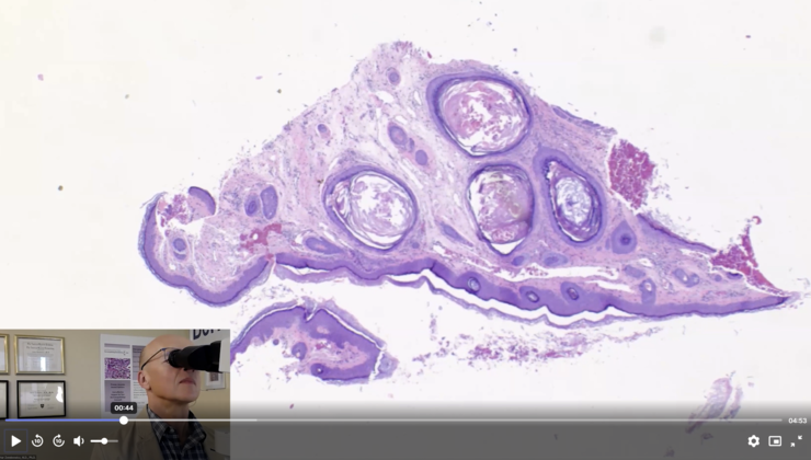 Endophytic Well Differentiated Squamous Proliferation | Dermpedia