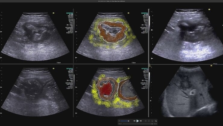 Tumora colonica stenozanta. Metastaze hepatice