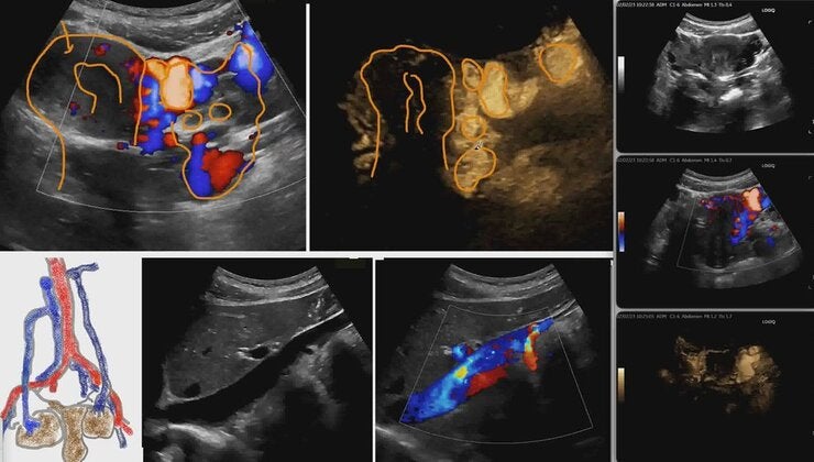 Boala varicoasa utero ovariana. Varice esofagiene