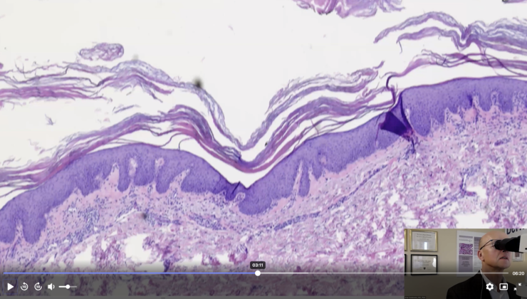 Pauciinflammatory Pityriasiform Rash In An Erythrodermic Patient ...