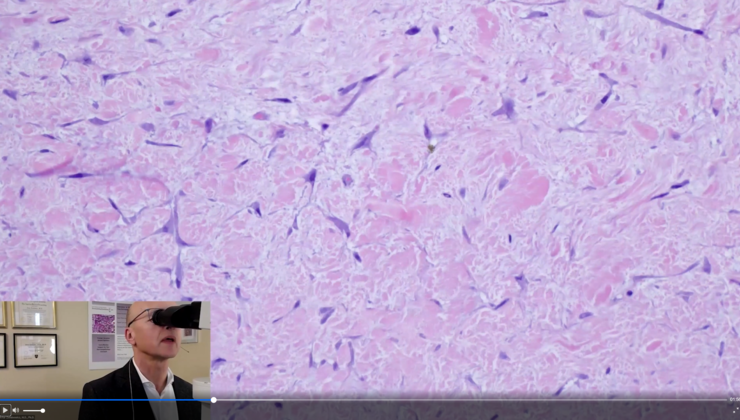 Subcutaneous Paucicellular Avascular Subcutaneous Soft Tissue Tumor ...