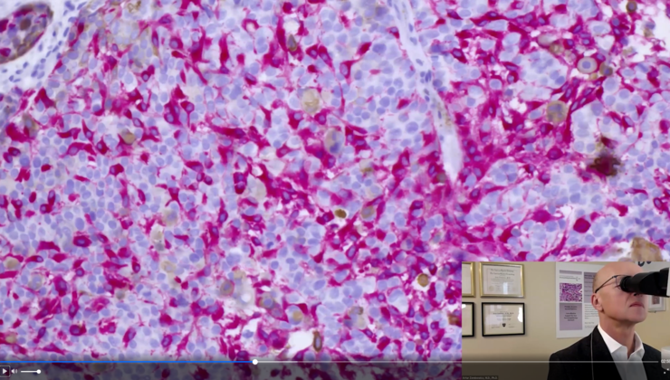 Mixed Squamo Melanocytic Neoplasm Melanocytic Matrixoma