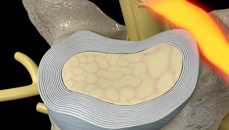 C7-T1 Disc Bulge - Right Side - Black Male - 1080p - 200092