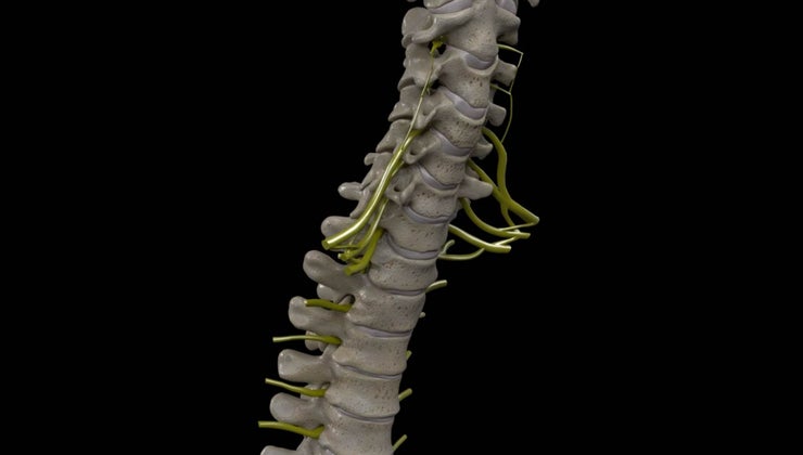 C7-T1 Disc Bulge - Left Side - Black Female - 1080p - 200083