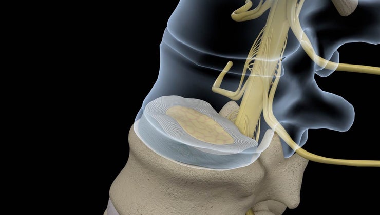 T11-T12 Disc Bulge - Right Side - Black Female - 1080p - 200331