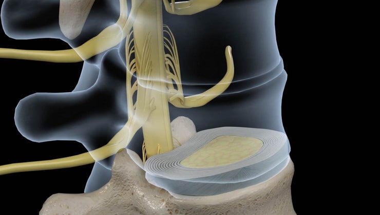 T8-T9 Disc Bulge - Left Side - Hispanic Female - 1080p - 200277