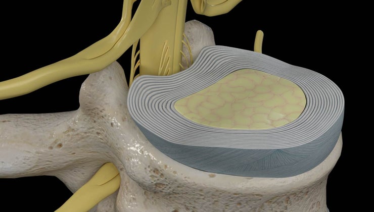 T6-T7 Disc Bulge - Left Side - Hispanic Female - 1080p - 200245