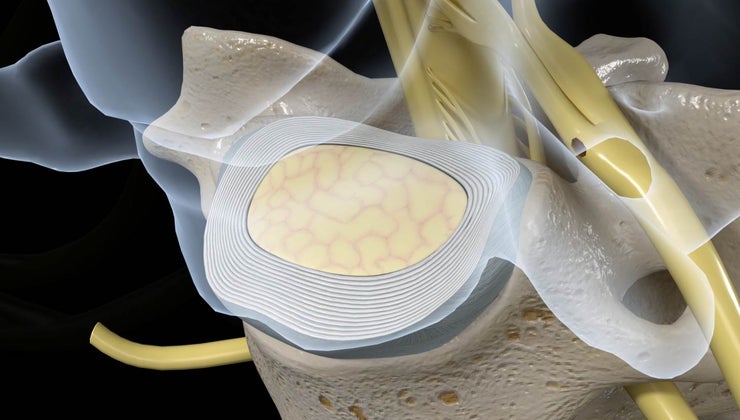 C6-C7 Disc Herniation - Right Side - Black Male - 1080p - 200412