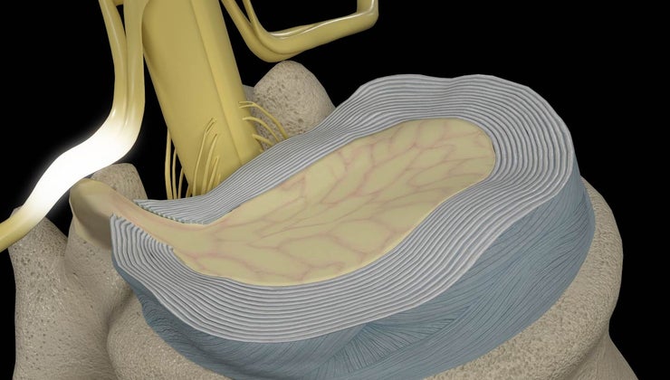 T11-T12 Disc Herniation - Right Side - Hispanic Male - 1080p - 200686